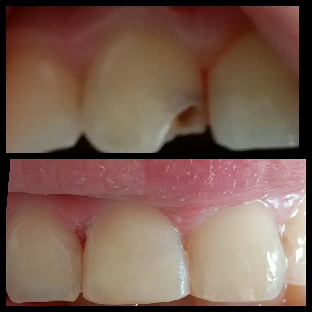 Plombiranje zuba - MAYA DENTAL OFFICE - 064/2410043